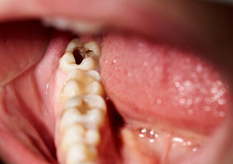 Dental Pulp Infections: Causes, Symptoms, and Treatment